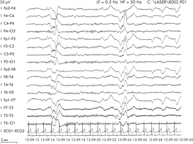 Encephalopathy with EEG based Grading | PPT | Brain and Nervous System ...