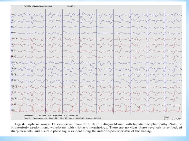 Encephalopathy with EEG based Grading | PPT | Brain and Nervous System ...