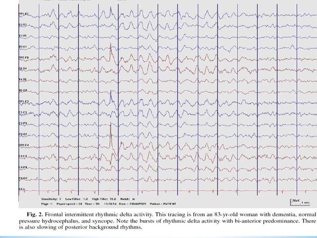 Encephalopathy with EEG based Grading | PPT | Brain and Nervous System ...