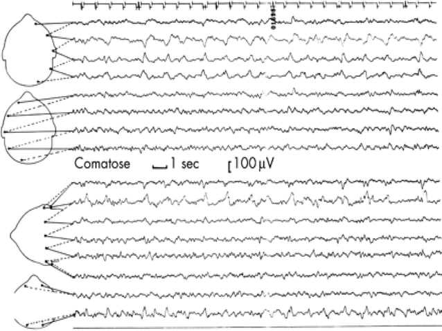 Encephalopathy with EEG based Grading | PPT | Brain and Nervous System ...