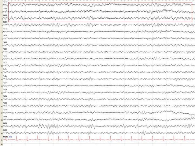 Encephalopathy with EEG based Grading | PPT | Brain and Nervous System ...