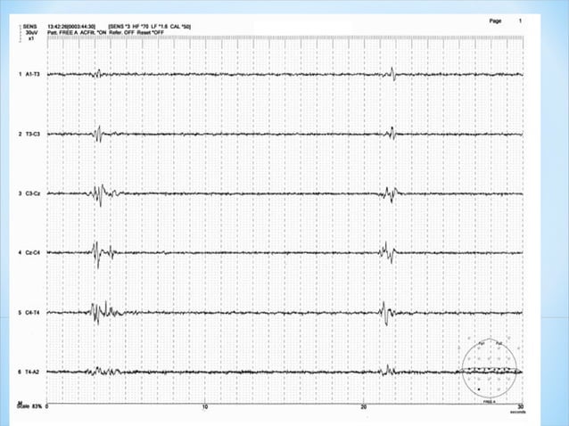 Encephalopathy with EEG based Grading | PPT | Brain and Nervous System ...