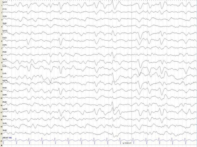 Encephalopathy with EEG based Grading | PPT | Brain and Nervous System ...