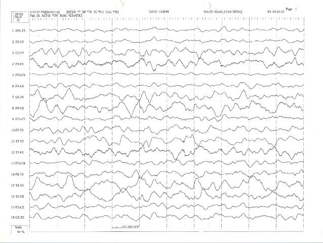 Encephalopathy With Eeg Based Grading