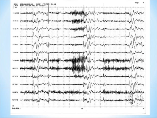 Encephalopathy With Eeg Based Grading