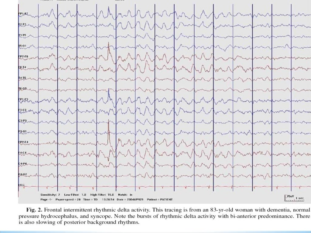 Encephalopathy with EEG based Grading
