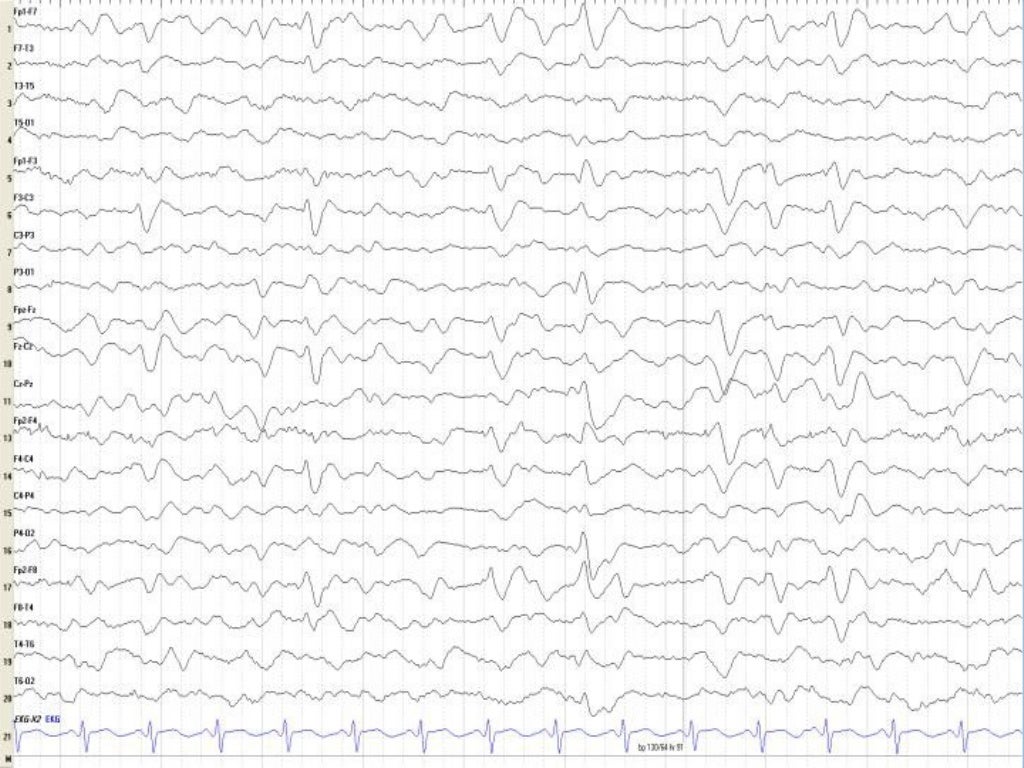Encephalopathy with EEG based Grading