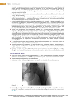 Enclavado intramedular fractura diaf femur | PDF