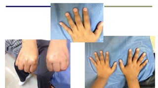Encondromatosis | PPTX