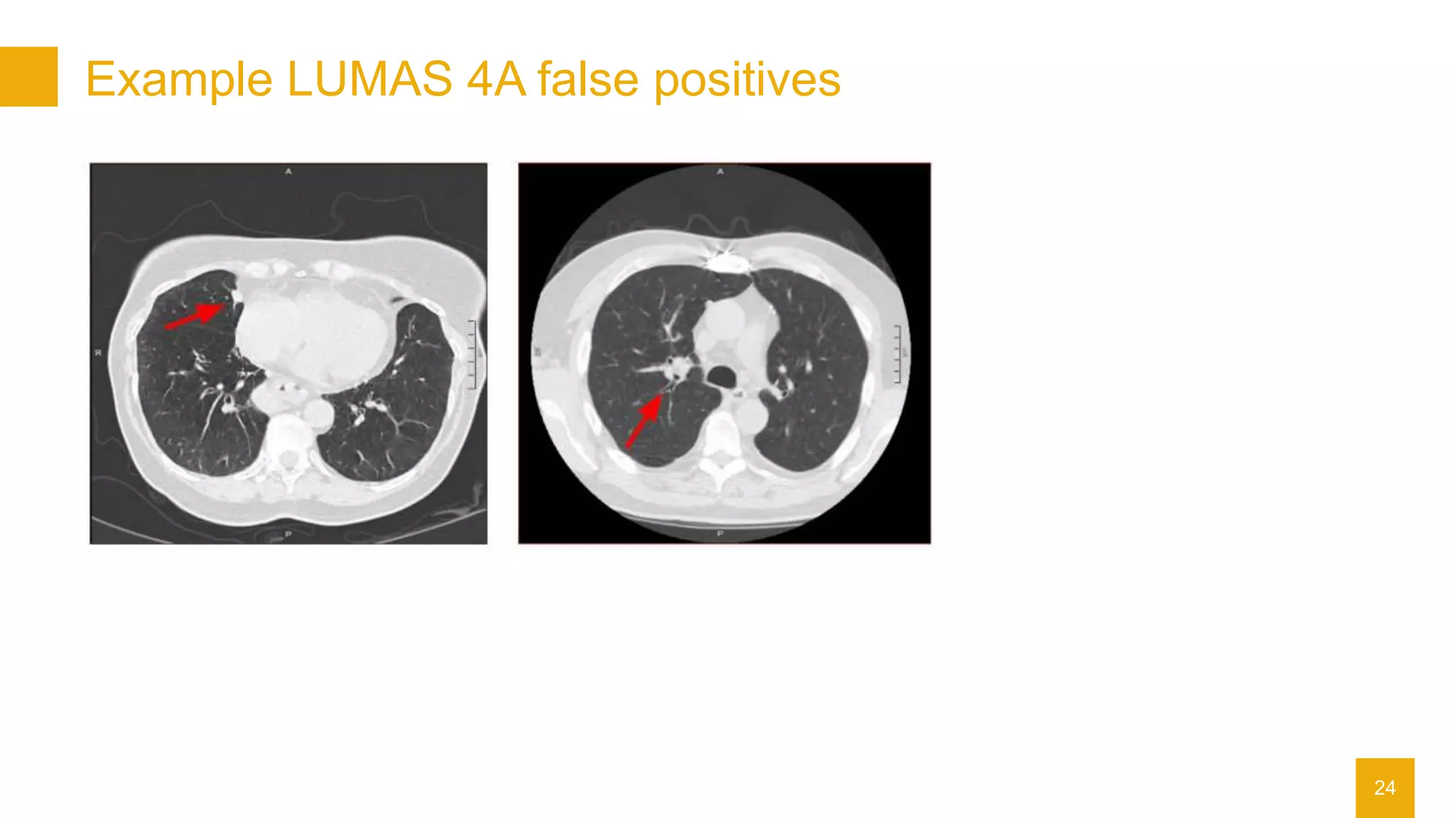 End To End Lung Cancer Screening With Three Dimensional Deep Learning