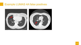 End to-end lung cancer screening with three-dimensional deep learning ...