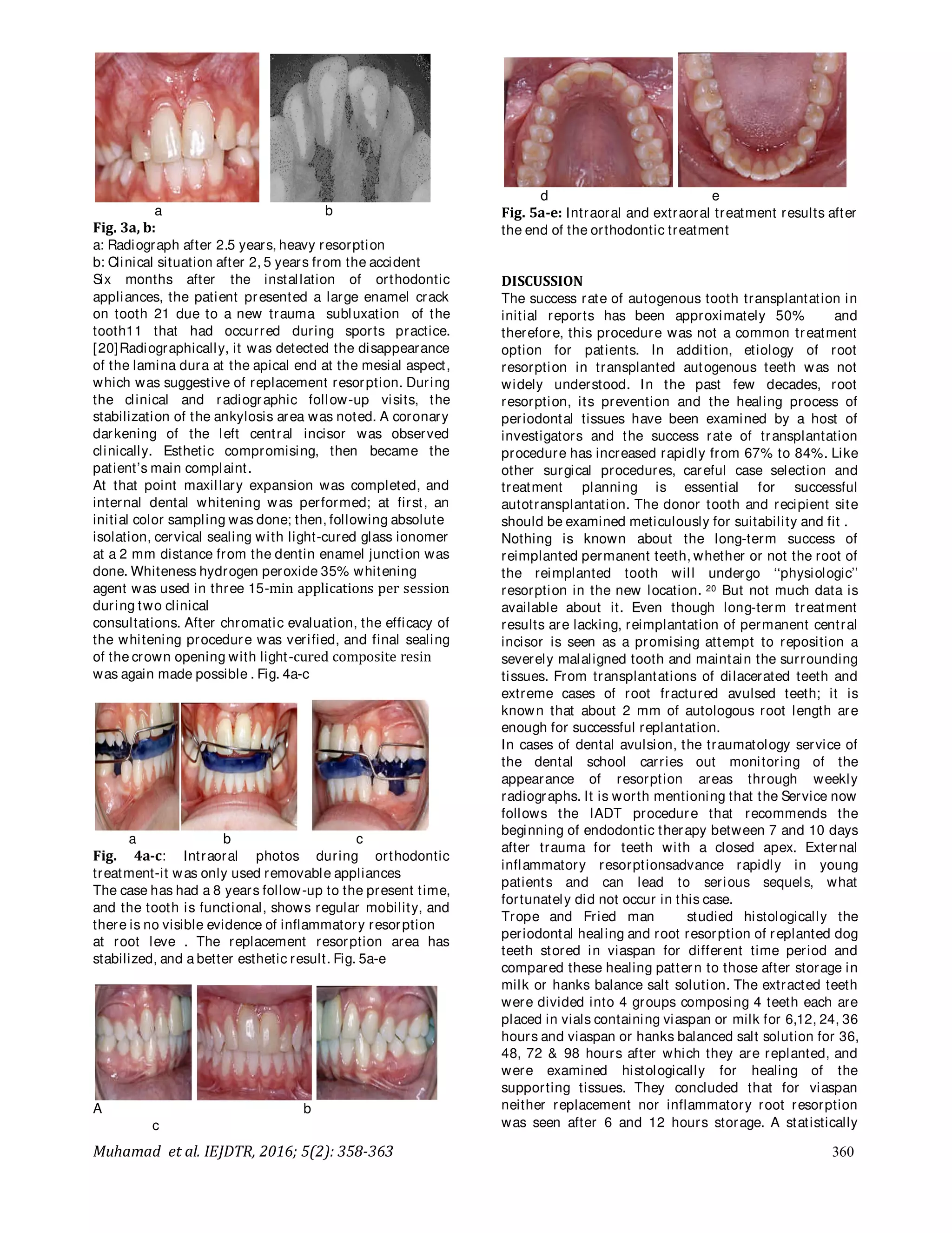 DENTAL AVULSION- IMMEDIATE REPLANTATION: 8- YEAR FOLLOW UP CASE | PDF