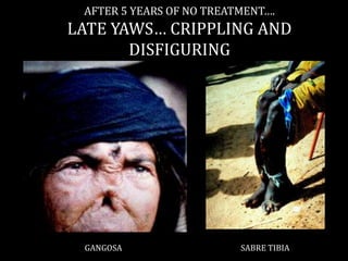 Endemic treponematoses | PPTX