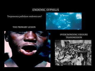 Endemic treponematoses | PPTX