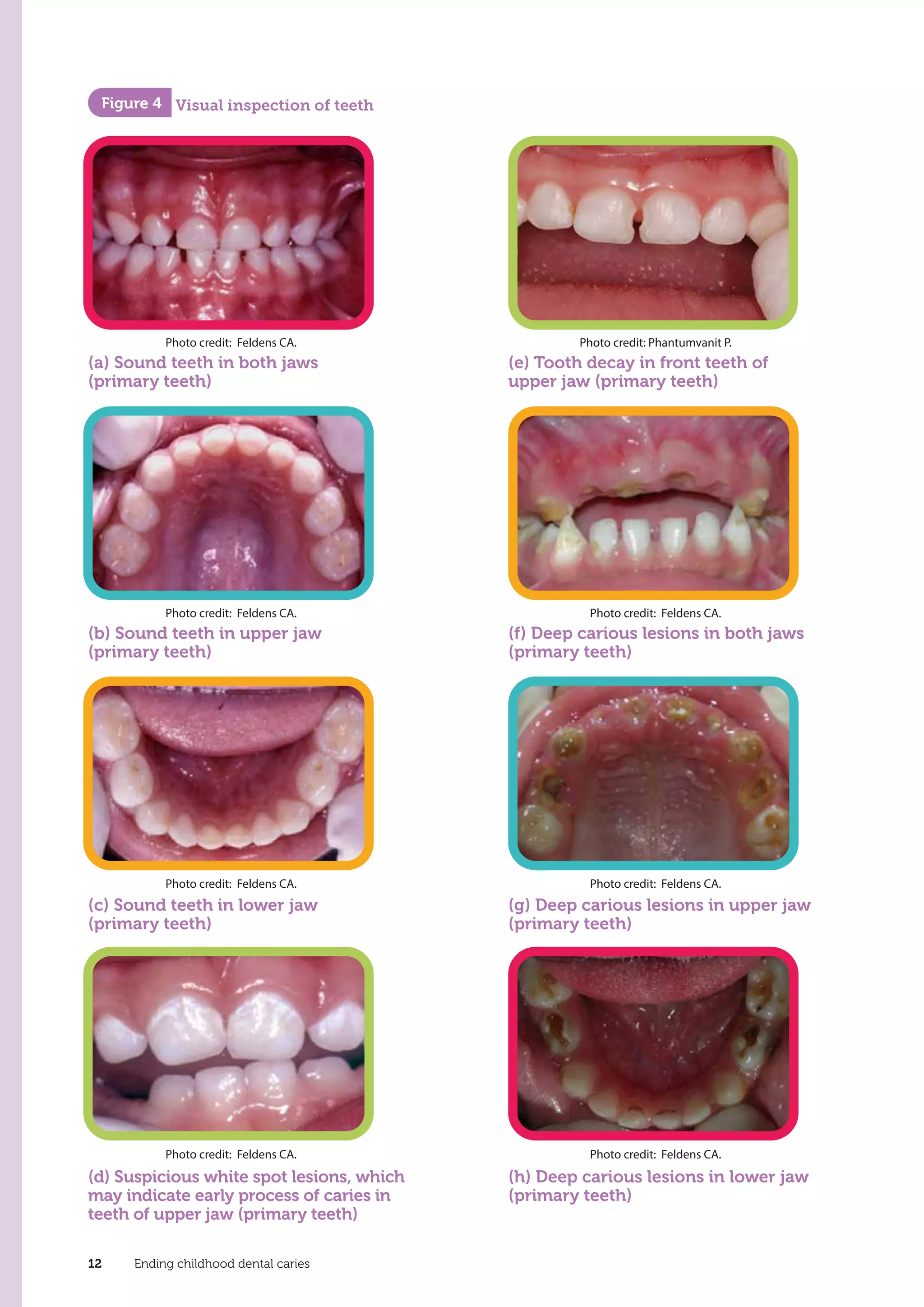 Ending early childhood caries | PDF