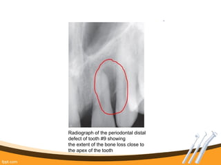 Cellular Allograft in the Treatment of a Severe Periodontal Infrabony ...