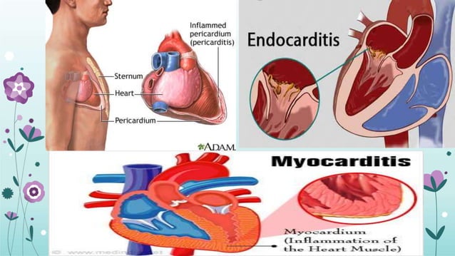 endocarditis pericarditis myocarditis | PDF | Heart and Cardiovascular Diseases | Diseases and ...