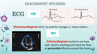 Endocarditis Ecg