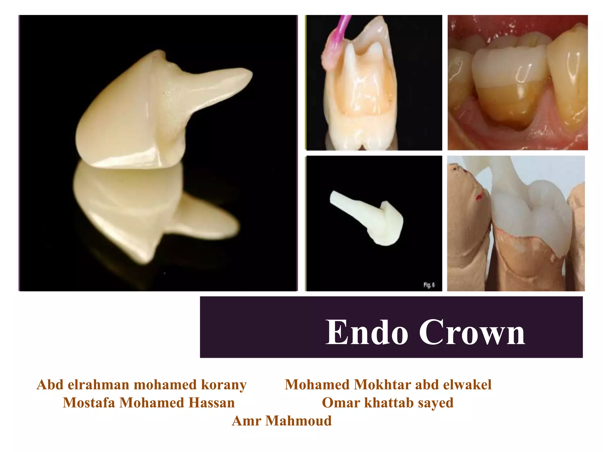 Endo crown | PPTX