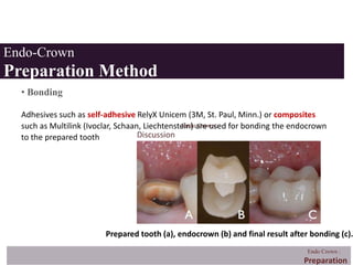 Endo crown | PPTX