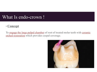 Endo crown | PPTX