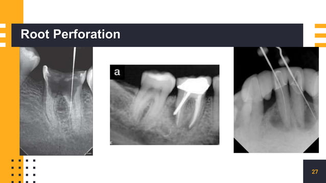 Endo Perio Lesions | PPTX