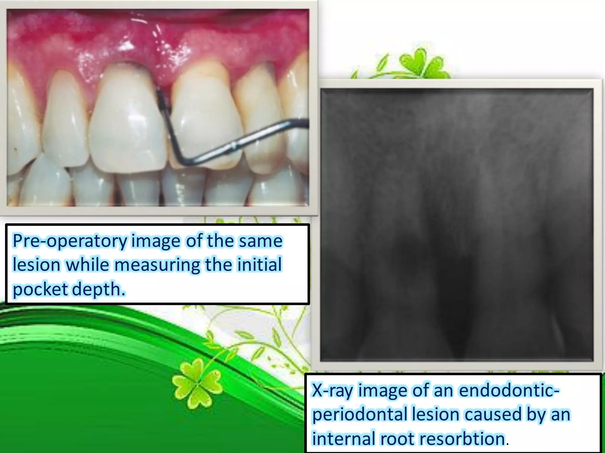 Endo perio lesions | PDF