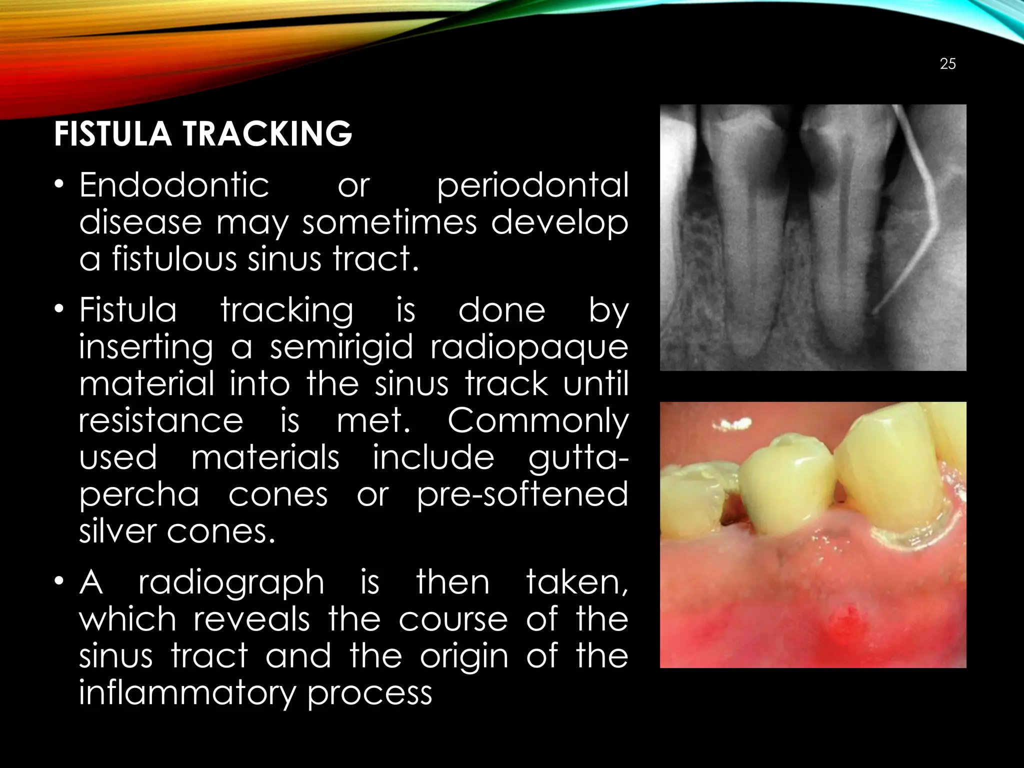ENDO-PERIO LESIONS is one and both pulp and periodontal tissue are ...