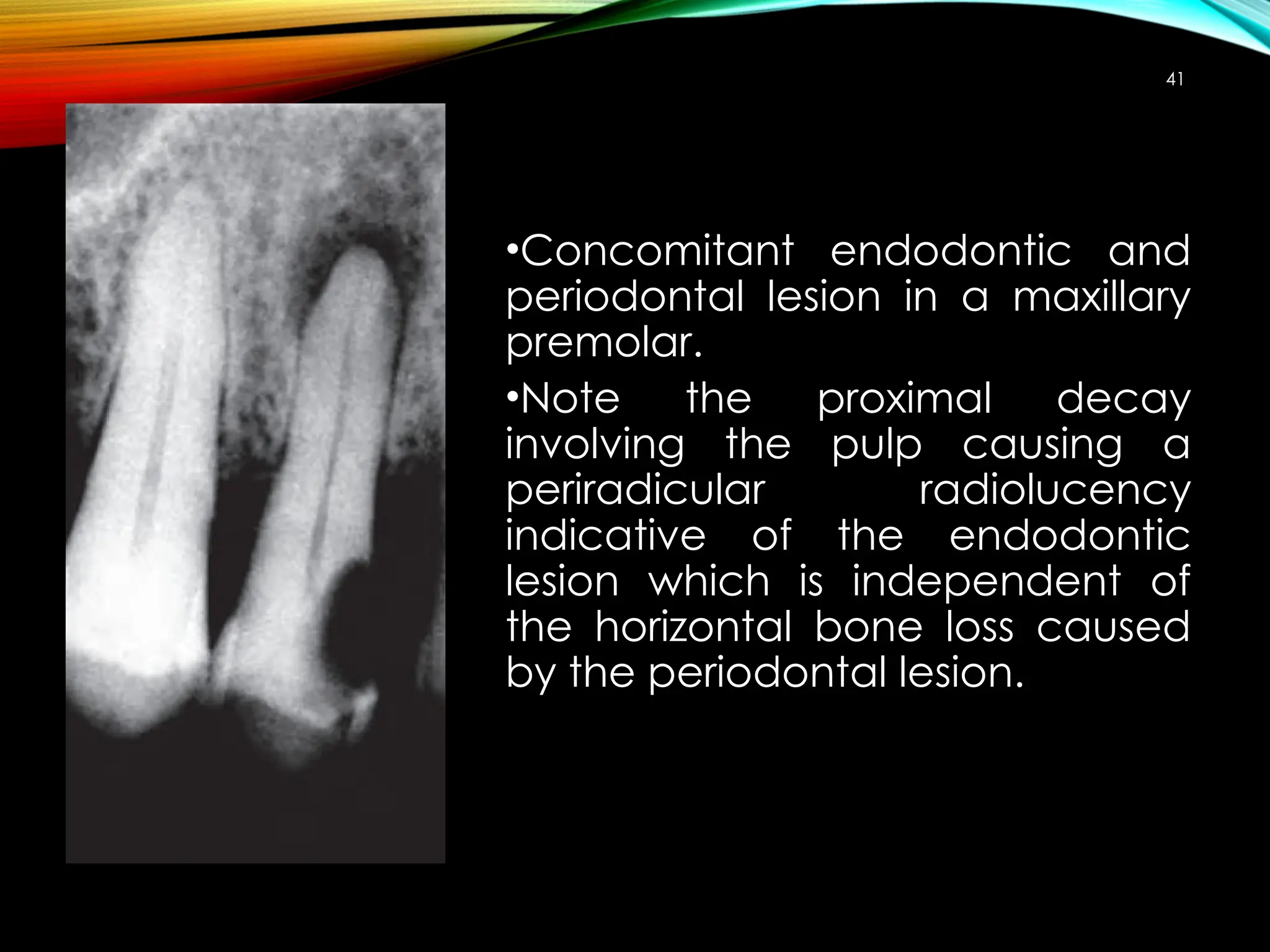 ENDO-PERIO LESIONS is one and both pulp and periodontal tissue are ...