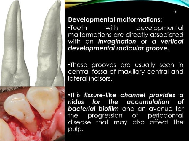 ENDO-PERIO LESIONS is one and both pulp and periodontal tissue are ...