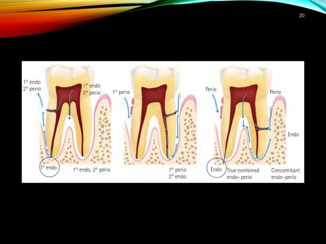 ENDO-PERIO LESIONS is one and both pulp and periodontal tissue are ...