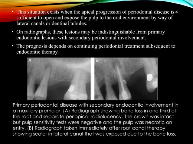 ENDO-PERIO LESIONS is one and both pulp and periodontal tissue are ...