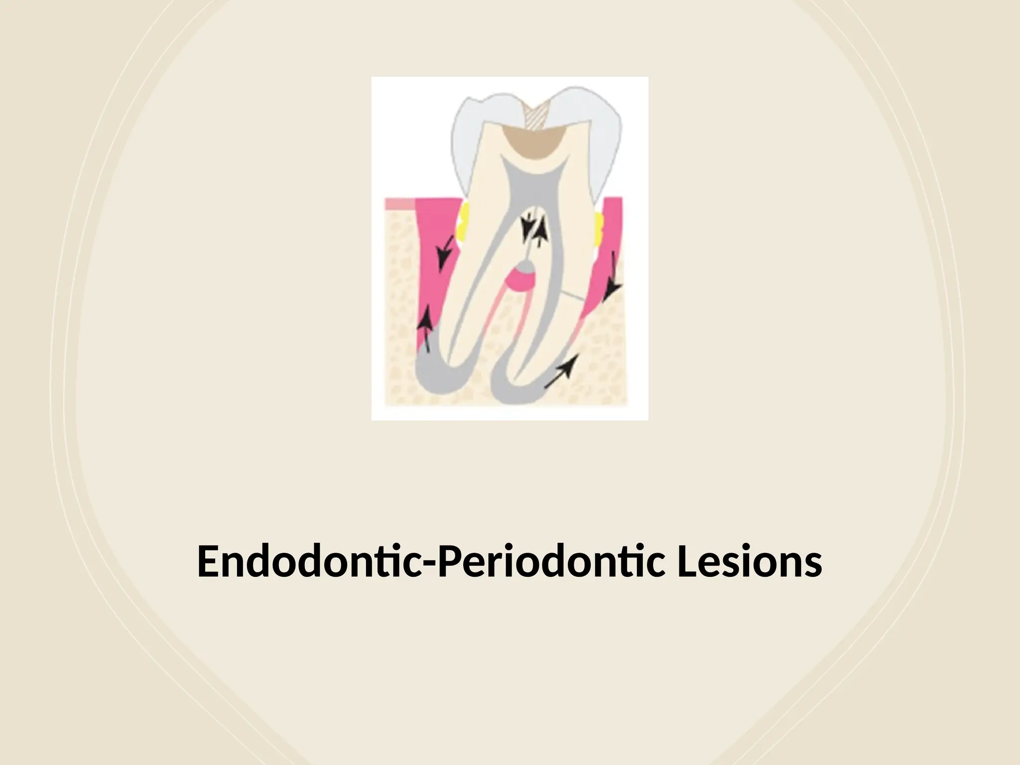 endo-perio lesions or perio endo lesion16-06-21.pptx