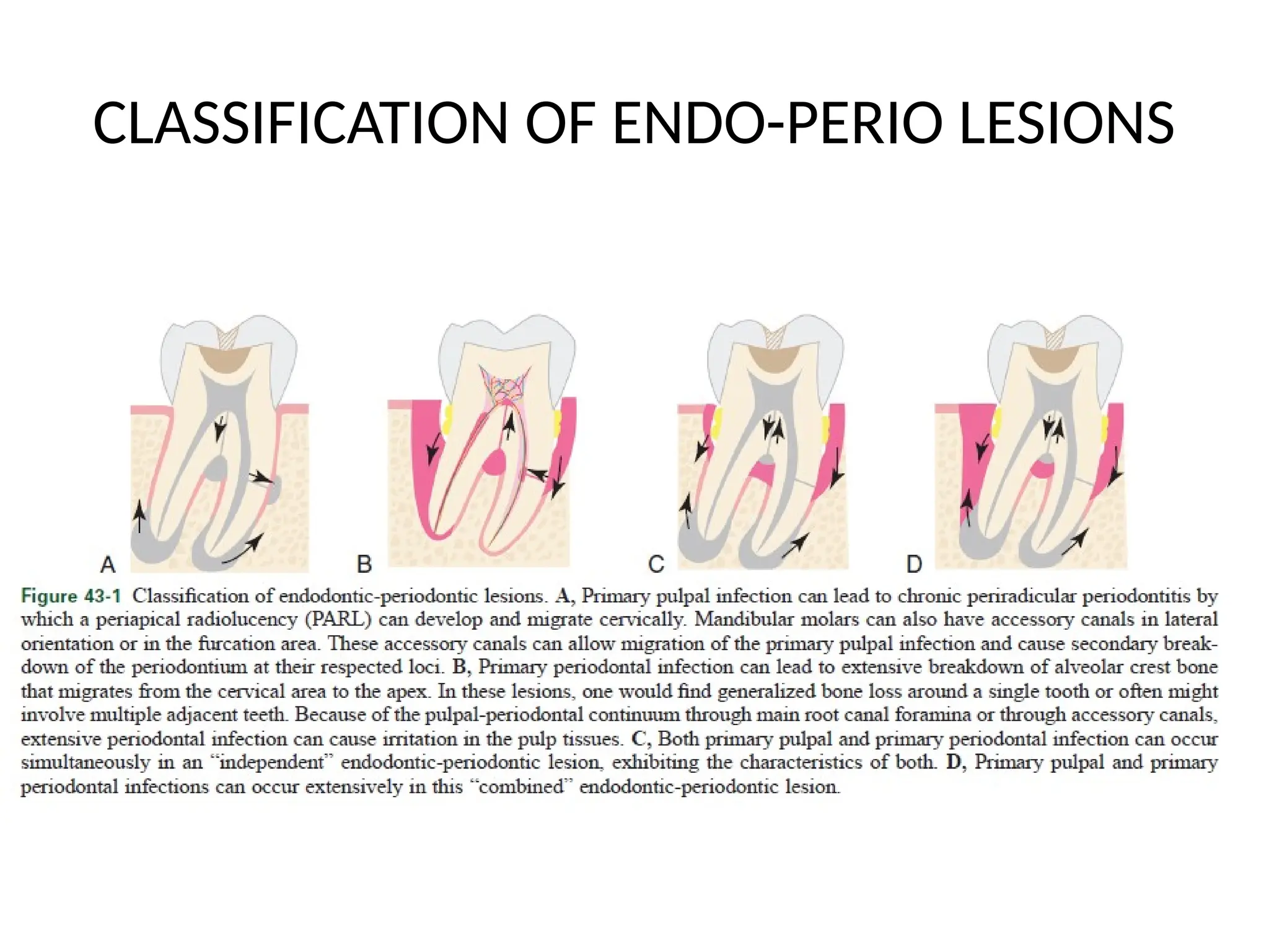 endo-perio lesions or perio endo lesion16-06-21.pptx