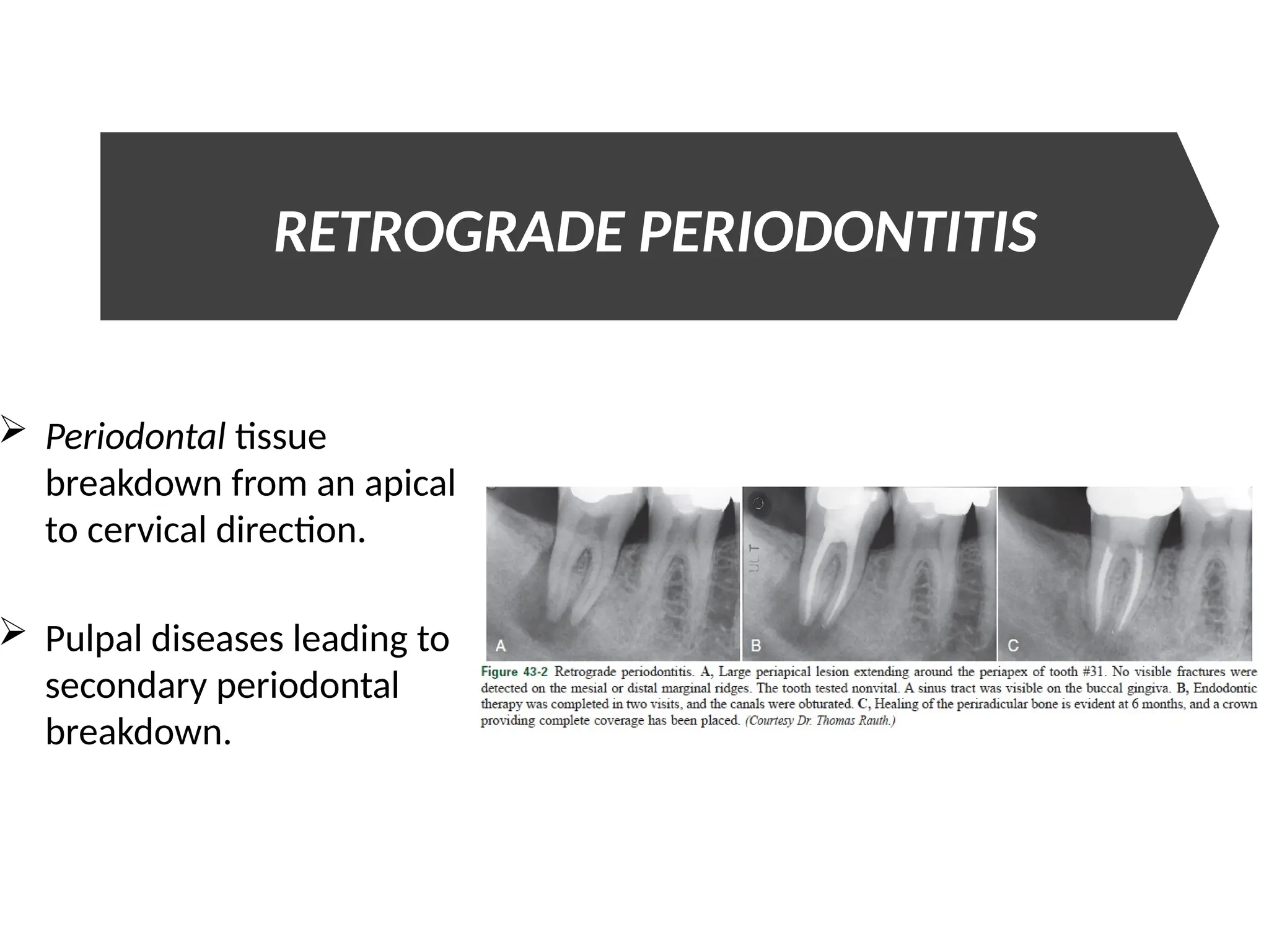 endo-perio lesions or perio endo lesion16-06-21.pptx