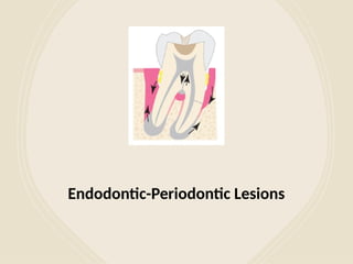 endo-perio lesions or perio endo lesion16-06-21.pptx