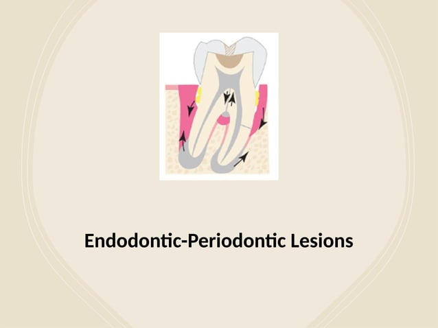 endo-perio lesions or perio endo lesion16-06-21.pptx