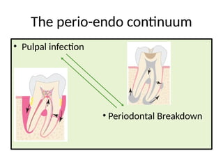 endo-perio lesions or perio endo lesion16-06-21.pptx