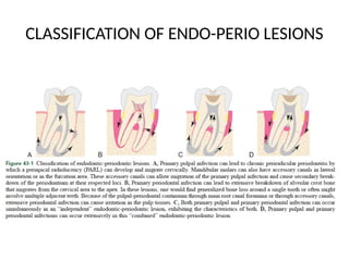 endo-perio lesions or perio endo lesion16-06-21.pptx