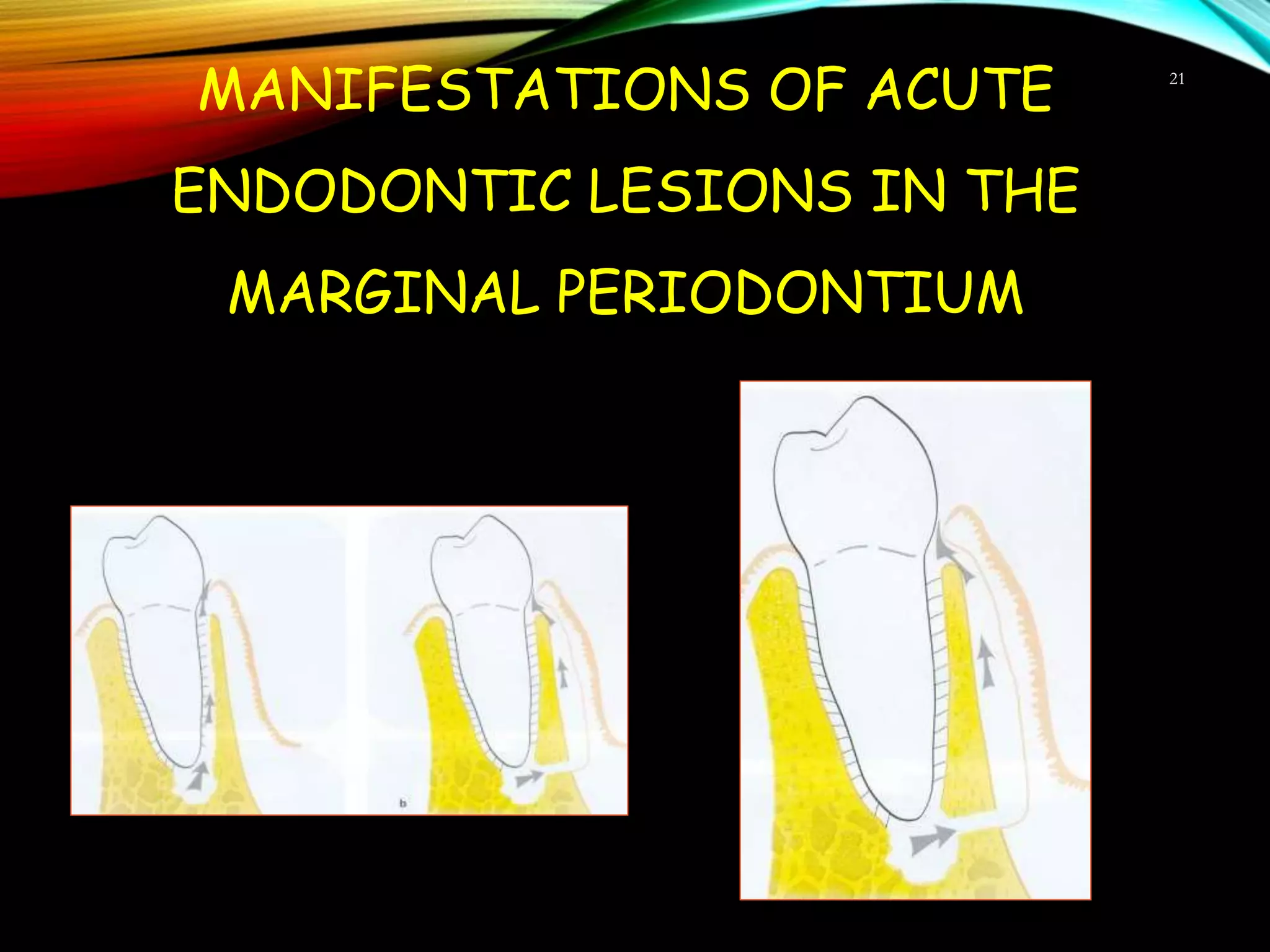 ENDO-PERIO LESIONS.ppt