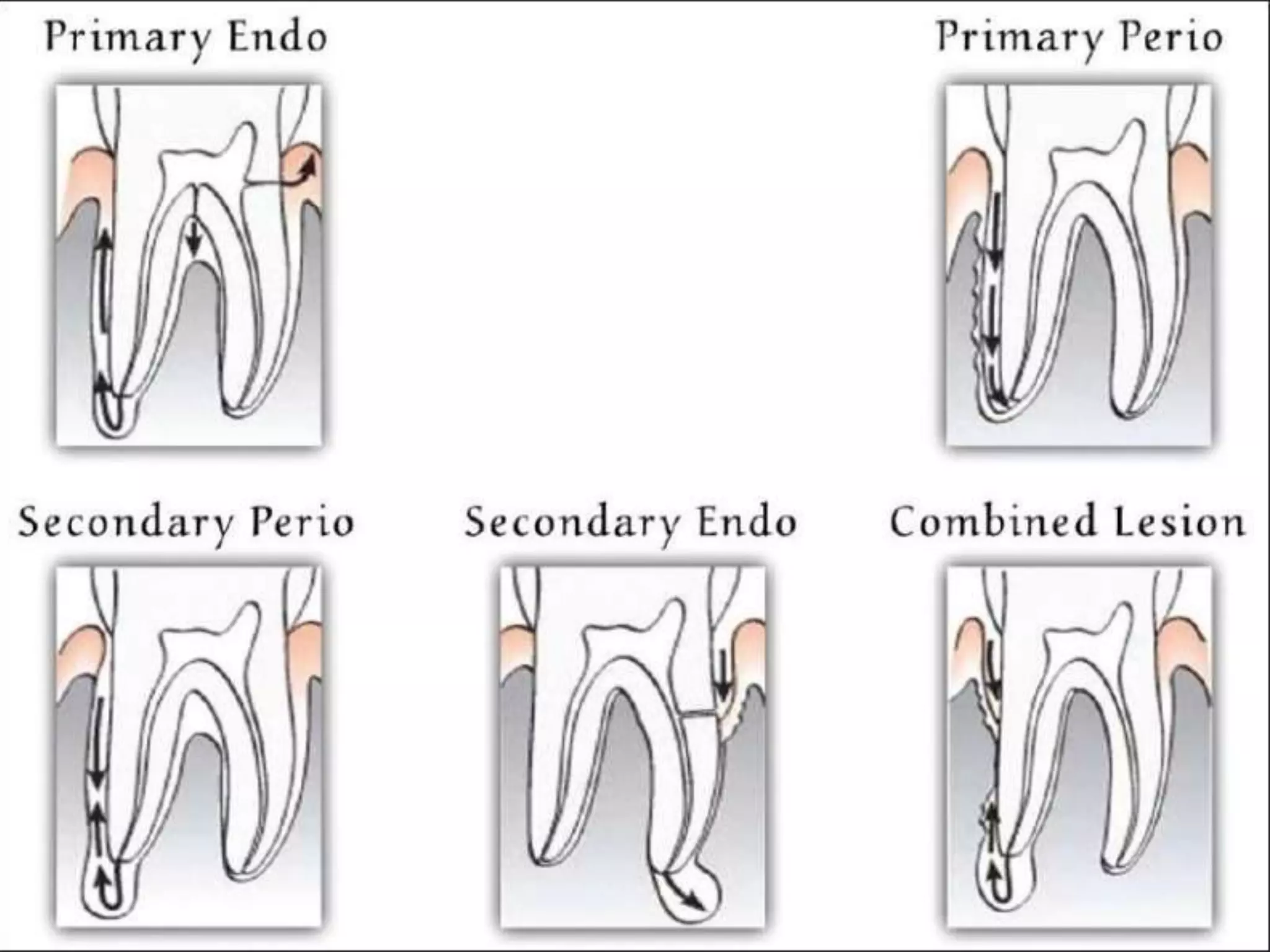 Endo-Perio relationship | PPTX