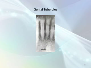 Genial Tubercles Xray