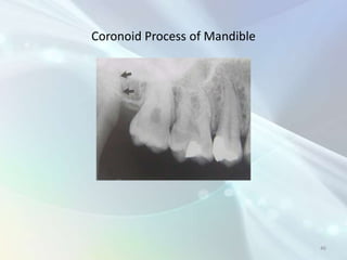 Coronoid Process Radiography