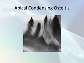 Alveolar Osteitis Radiograph