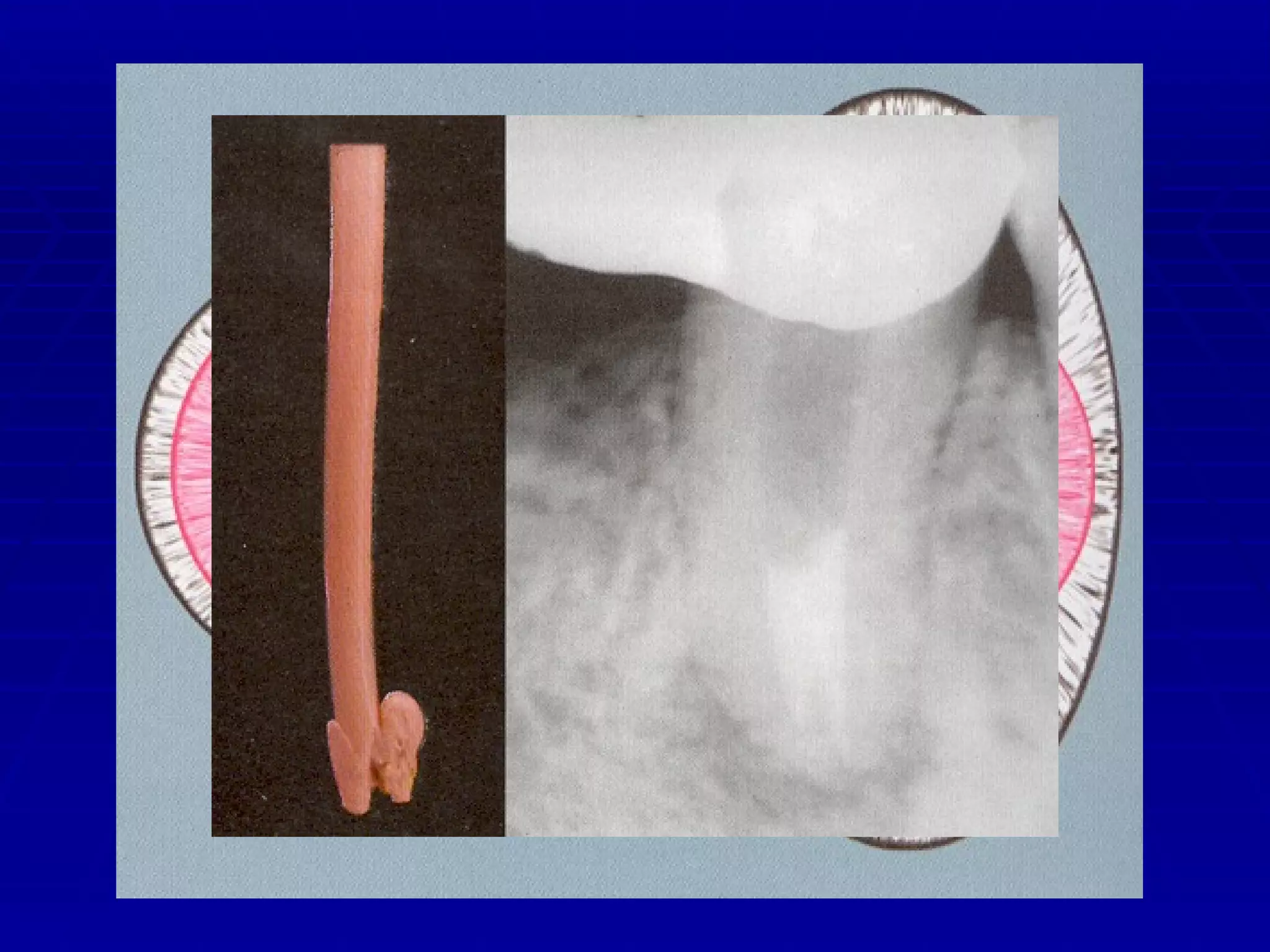 Endo01 12 Obturacion Del Conducto Radicular | PPT