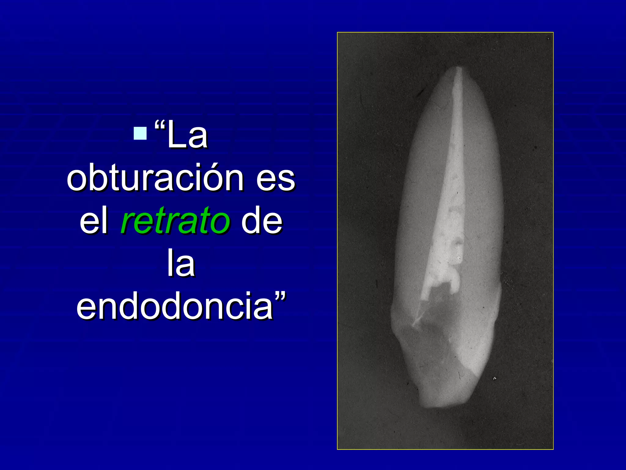Endo01 12 Obturacion Del Conducto Radicular | PPT