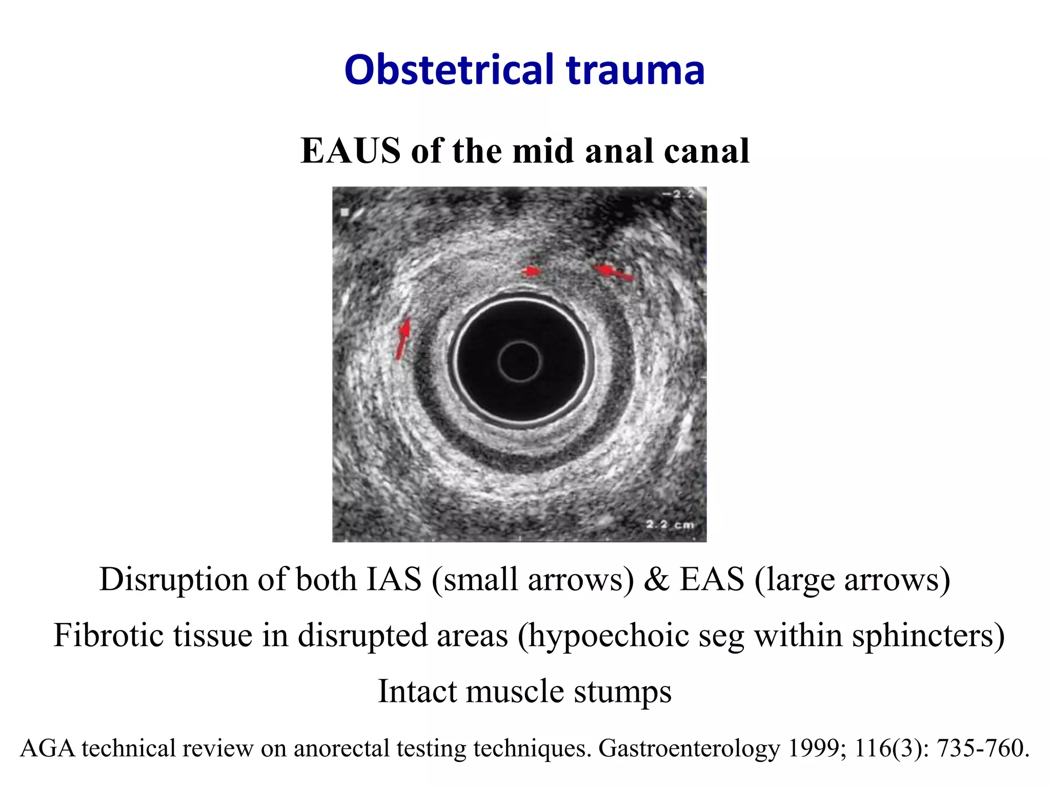 Endoanal ultrasound in anal diseases | PPTX