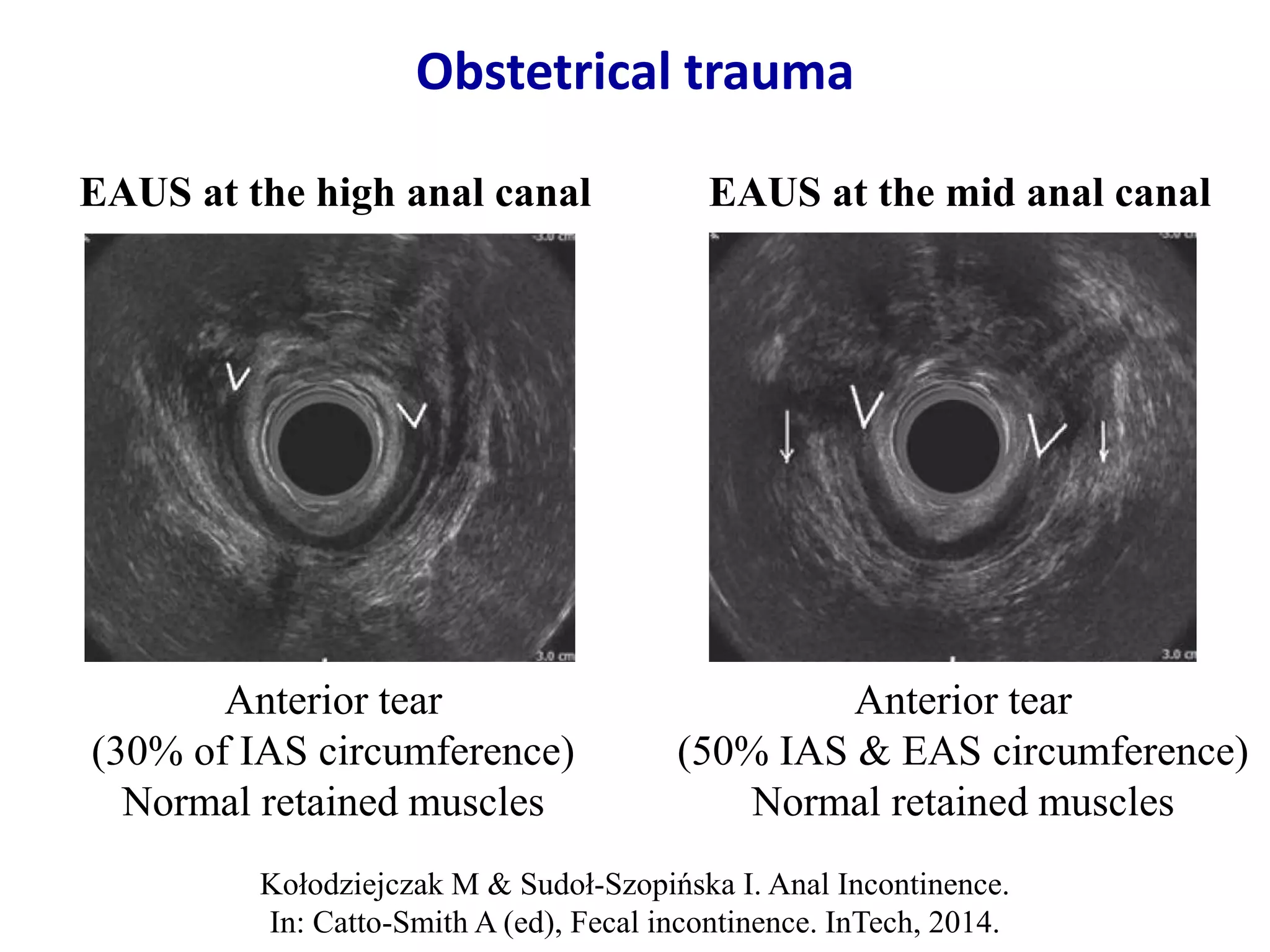 Endoanal ultrasound in anal diseases | PPTX