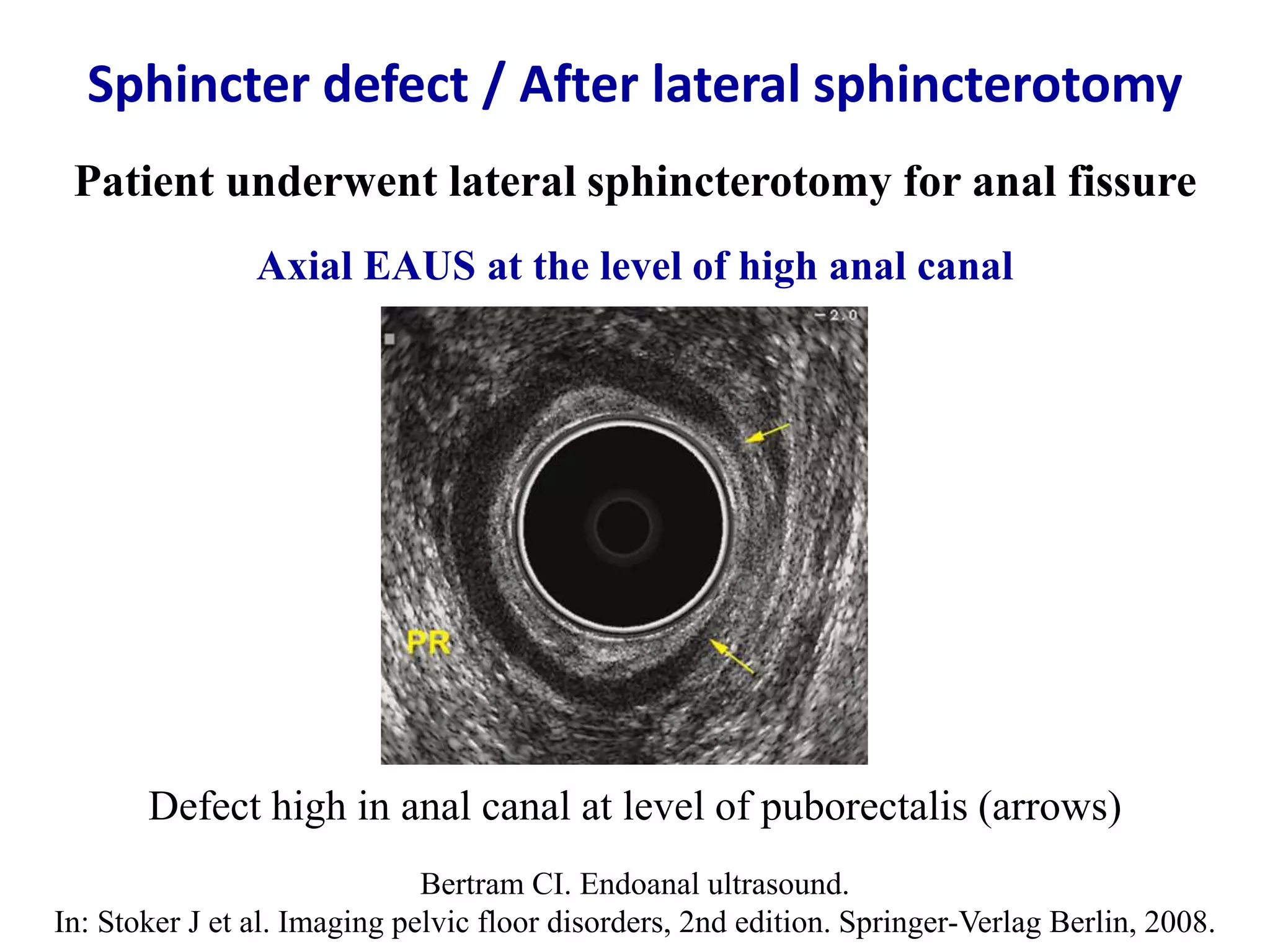 Endoanal ultrasound in anal diseases | PPTX