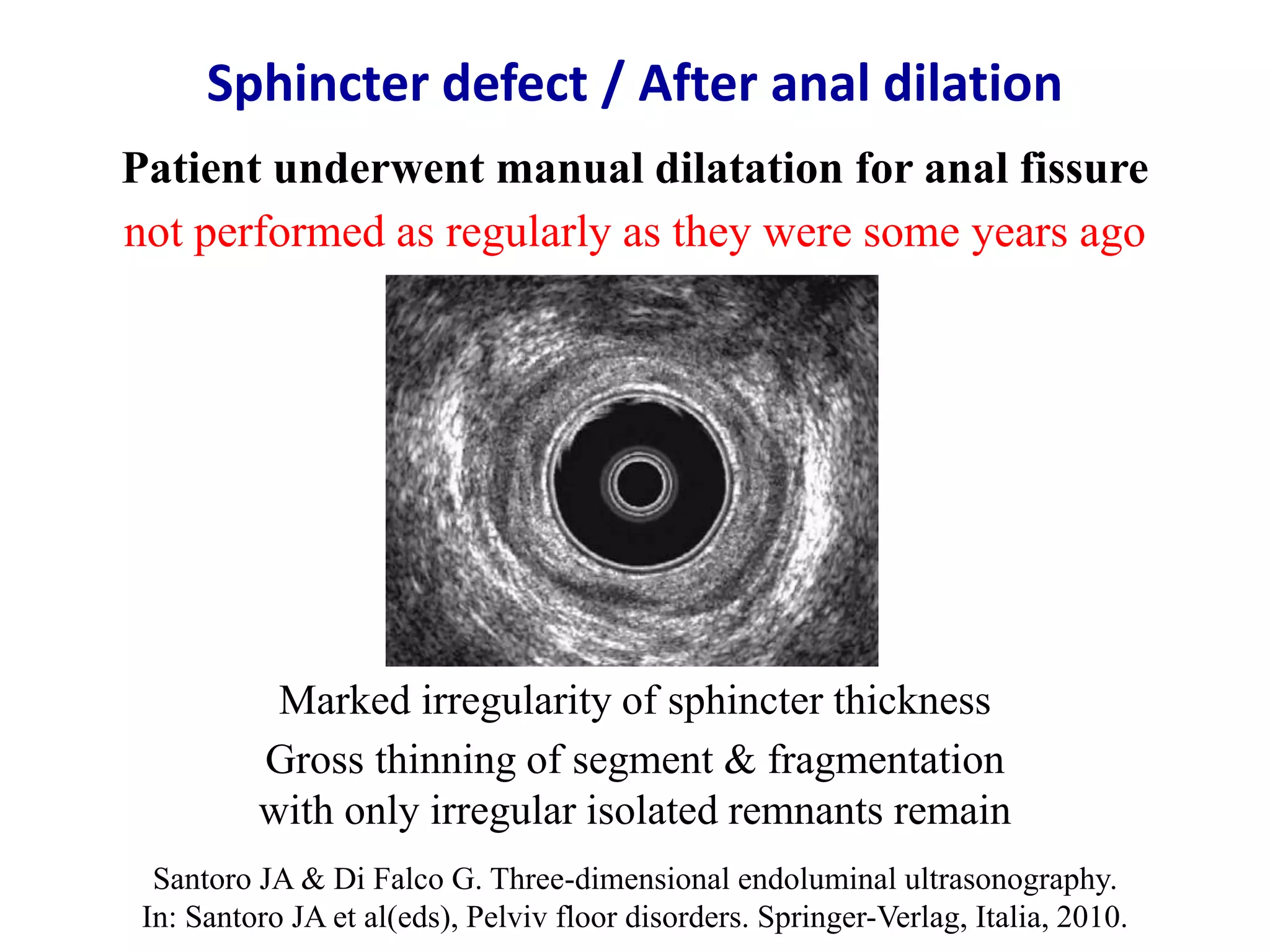 Endoanal ultrasound in anal diseases | PPTX
